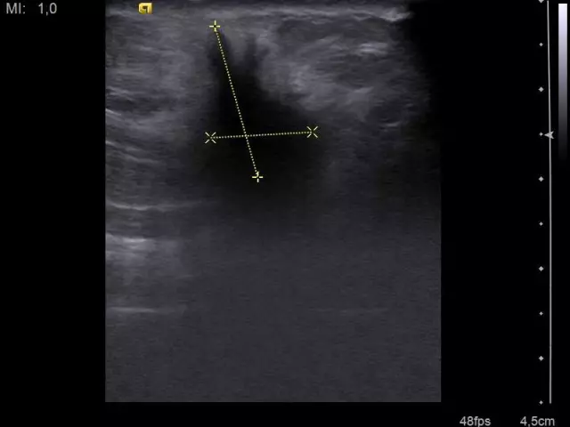Ultrazvuk dojki, Split | GINEKOLOŠKA ORDINACIJA DR. TAT