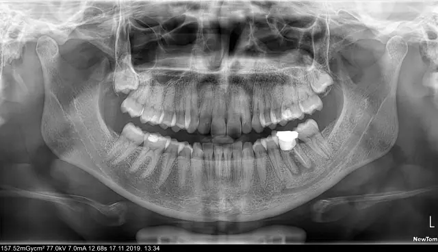 Zubni rendgen, RTG zuba, ortopan, Sisak | T DENTAL