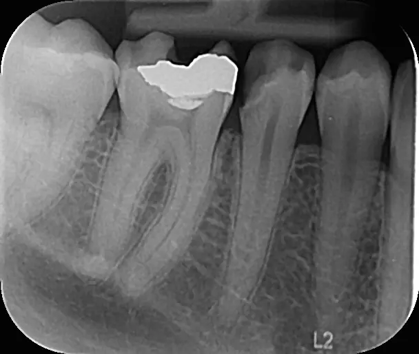 Zubni rendgen, RTG zuba, ortopan, Sisak | T DENTAL