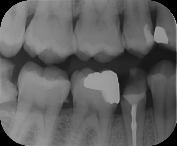 Zubni rendgen, RTG zuba, ortopan, Sisak | T DENTAL